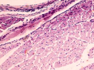 Rhabdomyolysis: Symptoms and Remedies | Organic Facts