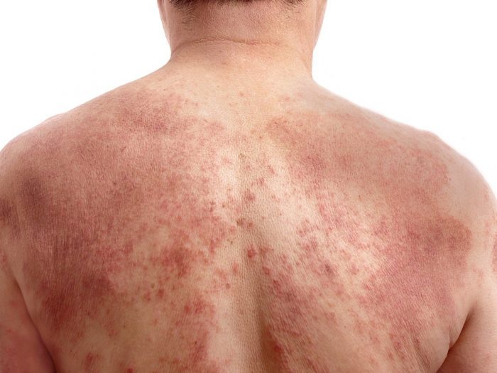 10 Useful Home Remedies for Rosacea | Organic Facts