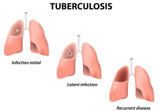 11 Surprising Home Remedies for Tuberculosis | Organic Facts